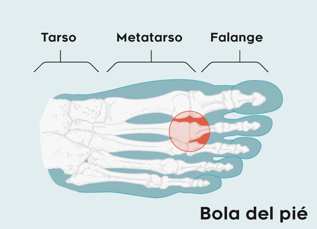 Metatarsalgia, síntomas, causas y tratamiento - Fisiolist